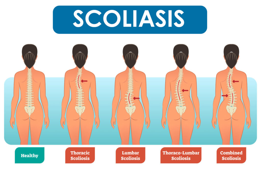 SCOLIASIS – The Chiro Rehab